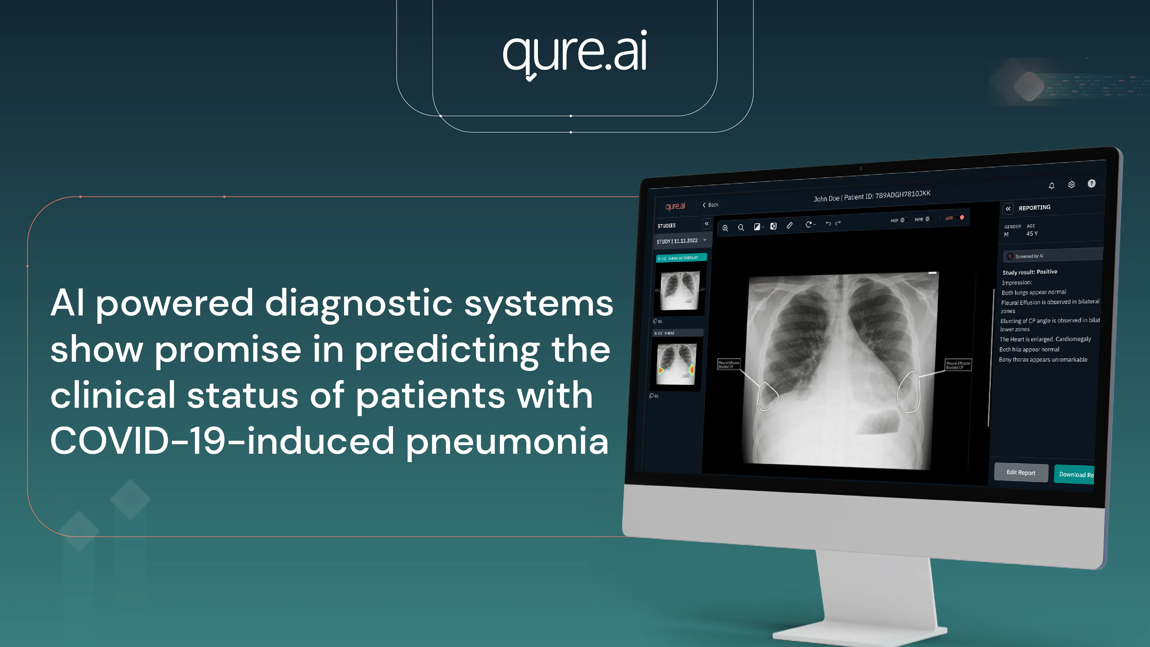 AI-Powered Diagnostic Systems detects COVID-19 Pneumonia