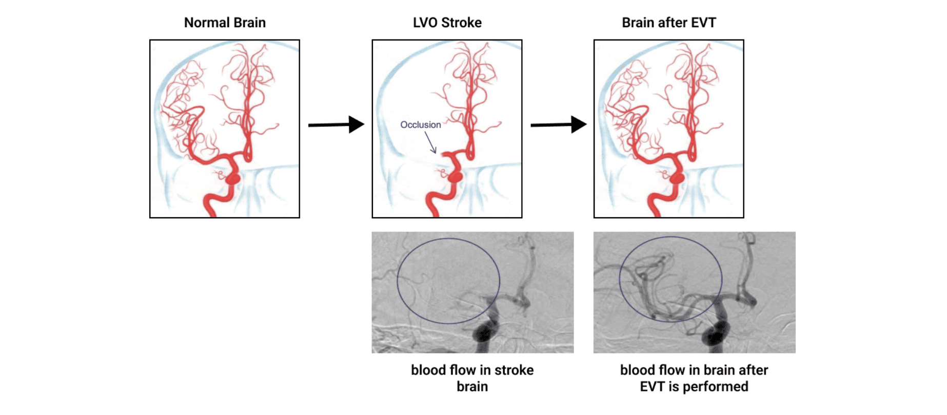 AI Algorithm for Rapid LVO Identification